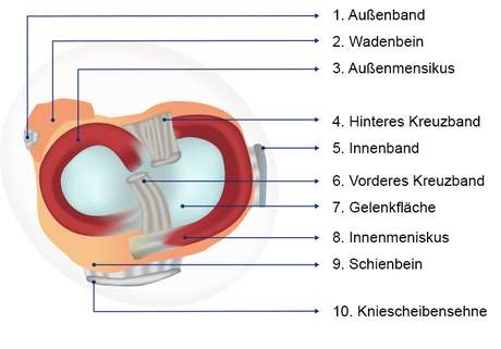 Meniskusriss: Ursachen | Knieschmerzen